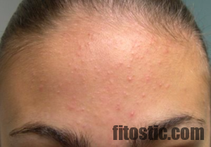 Comment Enlever Les Petit Bouton Blanc Sur Le Front