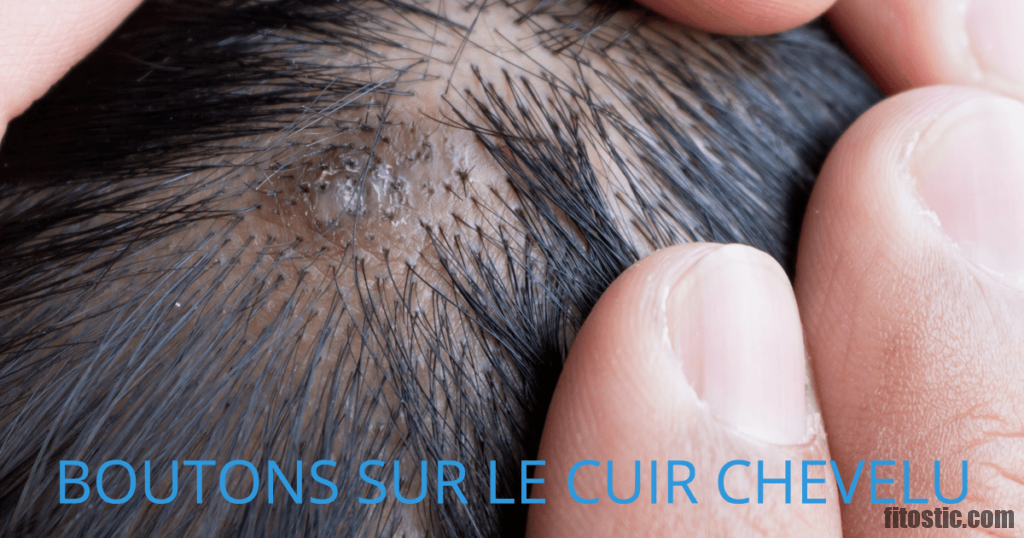 Pourquoi J'ai Des Boutons Sur Le Crâne