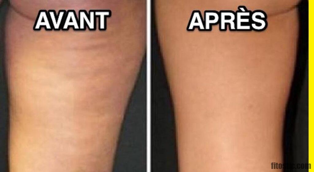 Comment Se Débarrasser Des Vergetures Définitivement