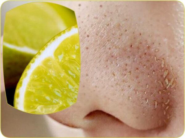 Comment Enlever Les Points Noirs Profonds