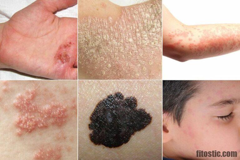 Comment Savoir Si On A Une Dermite Séborrhéique