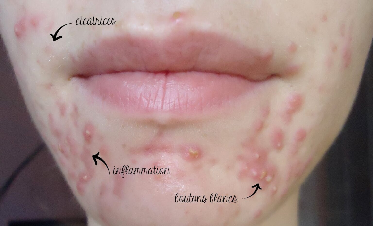 Pourquoi J'ai Des Boutons Sur Le Côté Du Visage