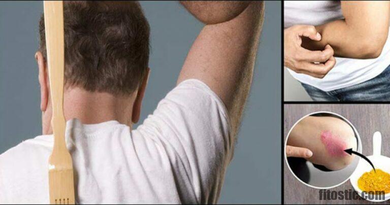 Comment Soigner Le Prurit Naturellement