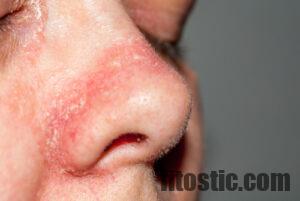 Quel Dermocorticoide Sur Le Visage