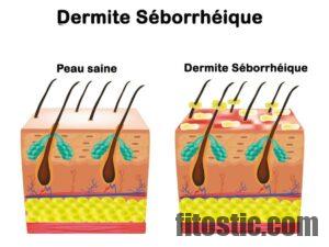 Comment Venir À Bout D'une Dermite Séborrhéique