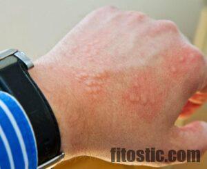 Comment reconnaître une éruption cutanée ? - Fitostic.com - Sport, Mode ...