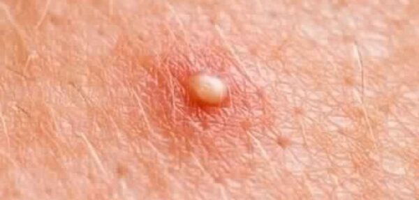 Comment savoir si on peut percer un bouton ? - Fitostic.com - Sport ...