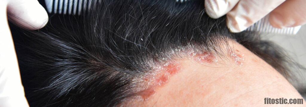 Comment soigner la teigne sur le cuir chevelu ? - Fitostic.com - Sport ...