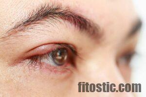 Comment soigner un orgelet sans ordonnance ? - Fitostic.com - Sport ...