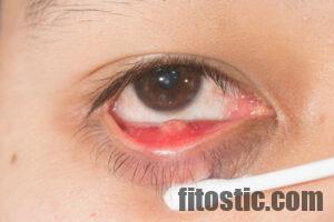 Comment soigner un orgelet vite ? - Fitostic.com - Sport, Mode, Beauté ...