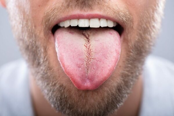 Comment soigner une angine blanche naturellement ? - Fitostic.com ...