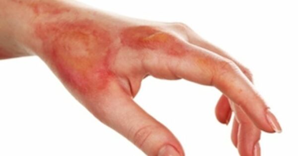 Comment soigner urticaire de contact ? - Fitostic.com - Sport, Mode ...