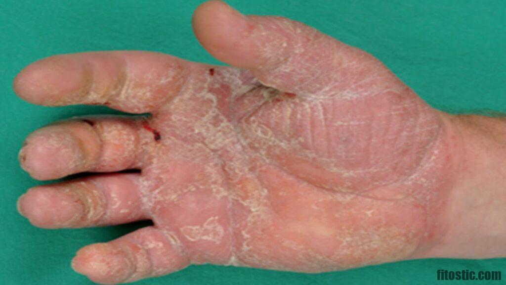 Comment traiter les champignons sur la peau naturellement ? - Fitostic ...