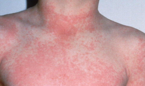 Est-ce que la scarlatine gratte ? - Fitostic.com - Sport, Mode, Beauté ...