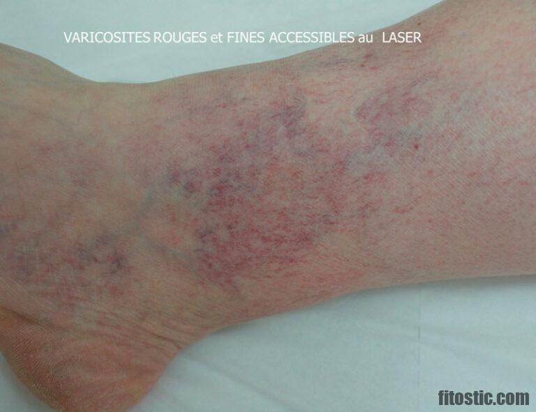 Pourquoi mes jambes sont rouges ? - Fitostic.com - Sport, Mode, Beauté ...