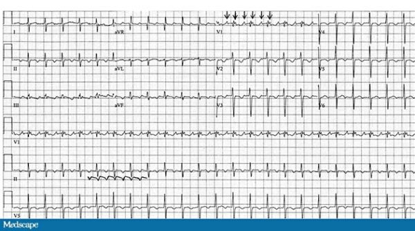 Quel est le rythme cardiaque idéal ? - Fitostic.com - Sport, Mode ...