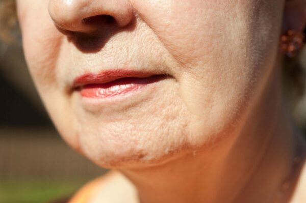 Quelle maladie provoque des boutons sur le corps ? - Fitostic.com ...