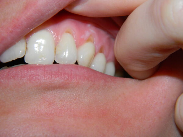 Qui consulter pour sinusite dentaire ? - Fitostic.com - Sport, Mode ...