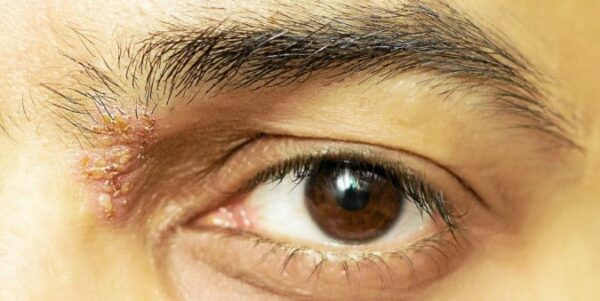 Qui consulter pour zona ophtalmique ? - Fitostic.com - Sport, Mode ...