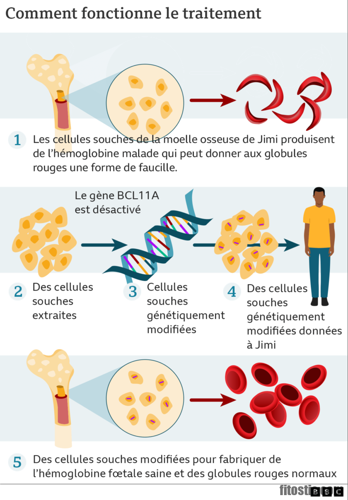 Comment Vivre Longtemps avec la Drépanocytose
