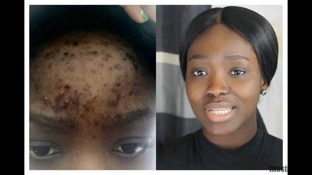 Comment enlever les tâche sur le front