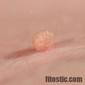 Comment reconnaître un acrochordon