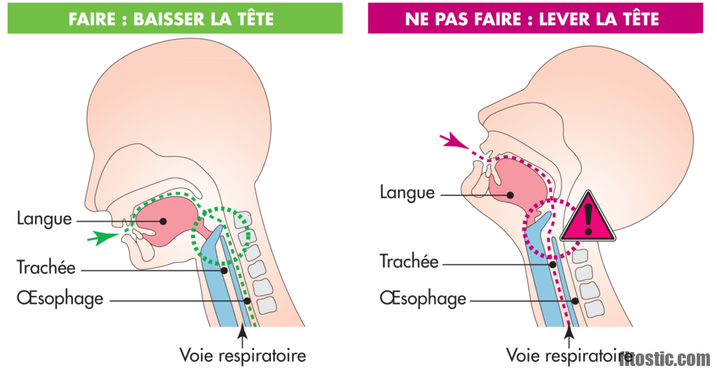 Quels sont les symptômes d'une fausse route Quels sont les symptômes d'une fausse route